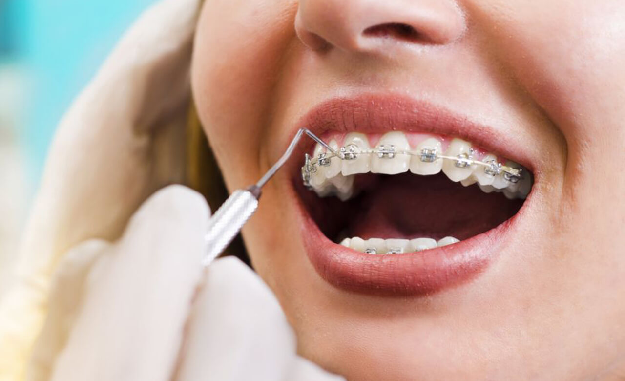 Brackets Dentales » Clínica Dental Cotrina Dentista en Pozuelo de Alarcón 🦷